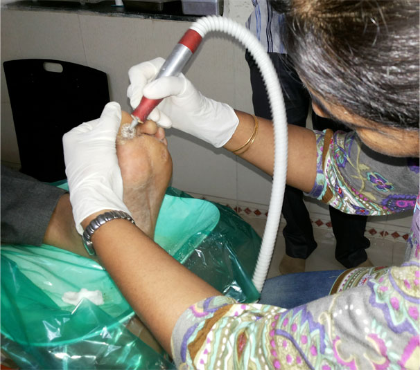 Feet First | Corns and Callosities